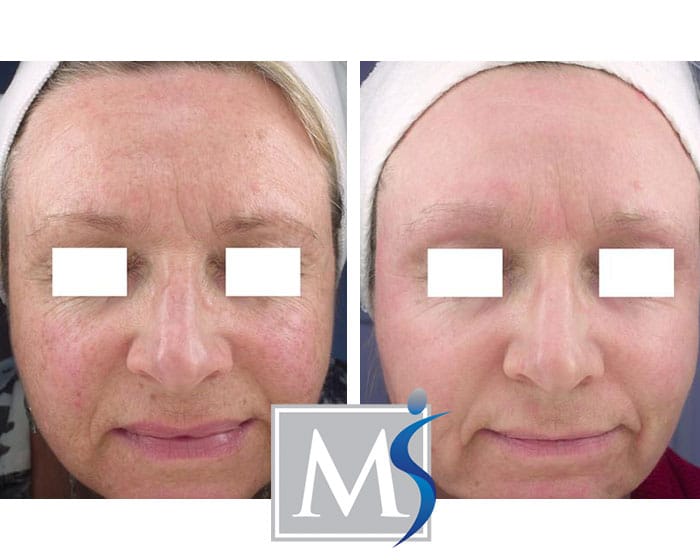 New York City Co2 CORE Laser Treatment | Matthew Schulman MD New York City Co2 CORE Laser Treatment | Matthew Schulman MD