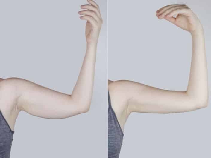 What Is a Mini Arm Lift? | Matthew Schulman, M.D.